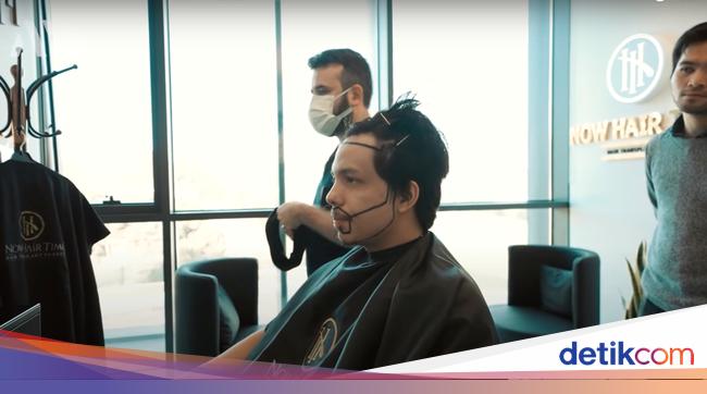 Foto 10 Artis Ini Transplantasi Rambut, Atta Halilintar Tanam Rambut di ...