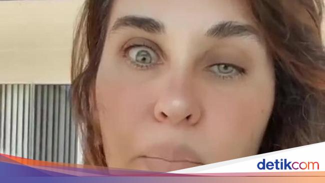 Penampilan Aneh Wanita Gagal Botox, Matanya Jadi Kecil Sebelah