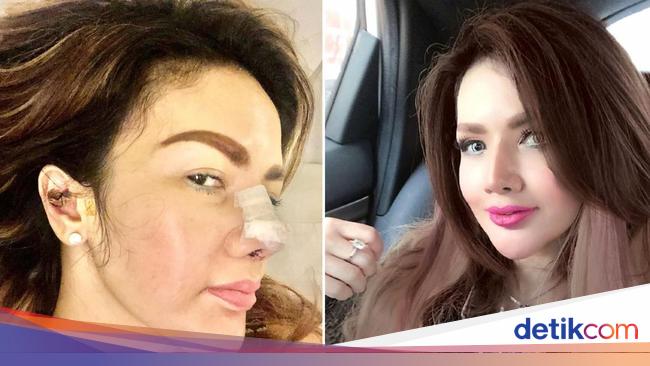 Penampakan 8 Artis Operasi Hidung Barbie Kumalasari Habiskan Rp 50 Juta 1974