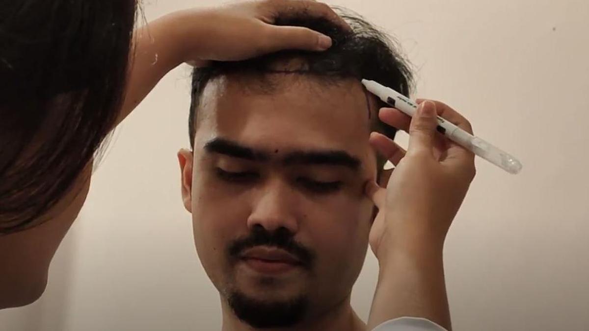 Berapa Lama Proses Tumbuhnya Rambut Usai Jalani Implan?