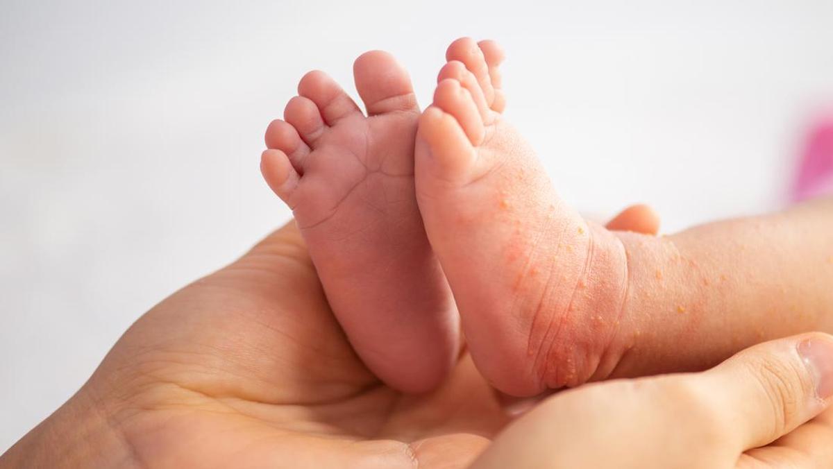 Sama-sama Picu Lenting di Kulit, Ini Beda Gejala Flu Singapura Vs Cacar