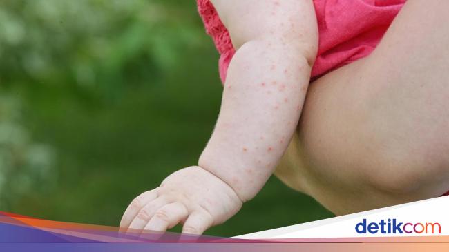 6 Perbedaan Bintik Merah DBD dan Biang Keringat, Jangan Keliru Lagi!