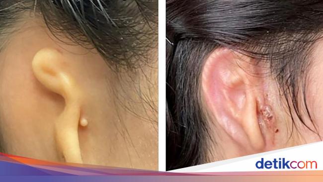 Wanita Ini Jadi Orang Pertama yang Dapat Transplantasi Telinga 3D