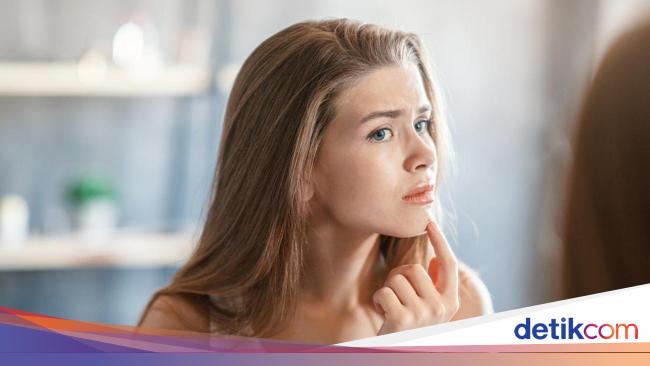 Jenis-jenis Jerawat di Wajah dan Cara Mengatasinya dari Komedo Hingga ...
