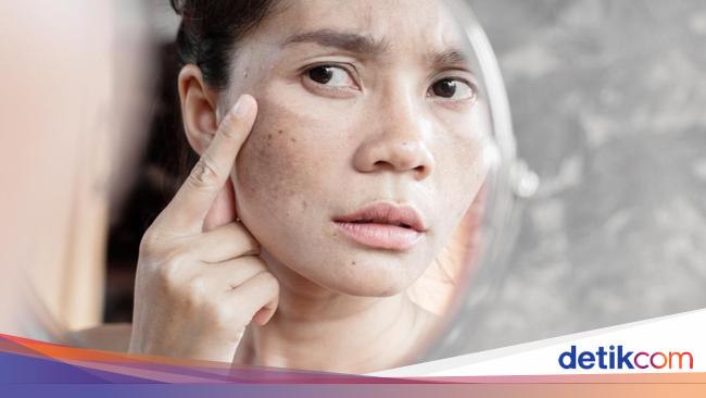 8 Cara Menghilangkan Flek Hitam di Wajah Secara Alami