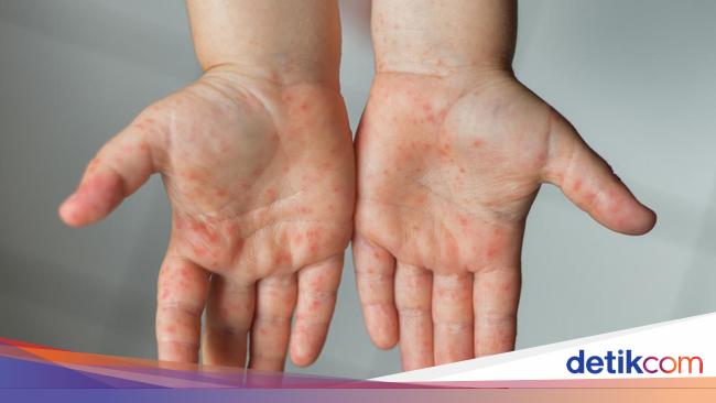 Penyebab Kasus Campak di RI Meroket 32 Kali Lipat