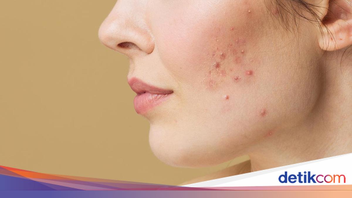 Kacang Bikin Jerawatan, Mitos atau Fakta?