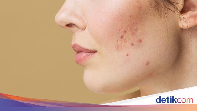 Kenali Penyebab Jerawat Nodul Hingga Cara Mengobatinya