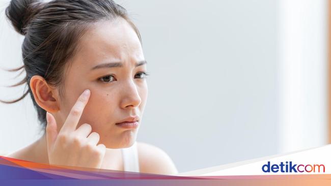Skin Barrier Rusak? Ini Ciri-ciri dan Cara Mengatasinya