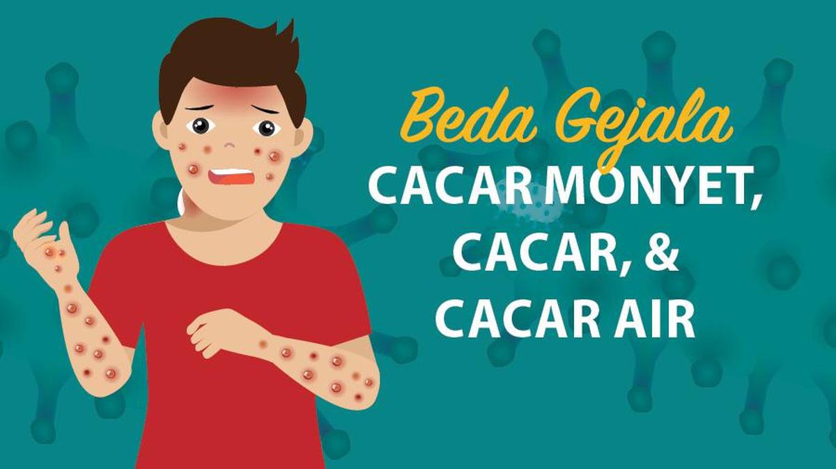 Beda Gejala Cacar, Cacar Air, dan Cacar Monyet