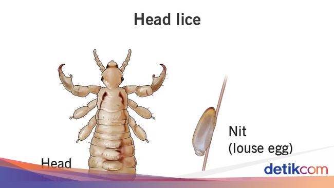 6 Cara Ampuh Membasmi Kutu Rambut