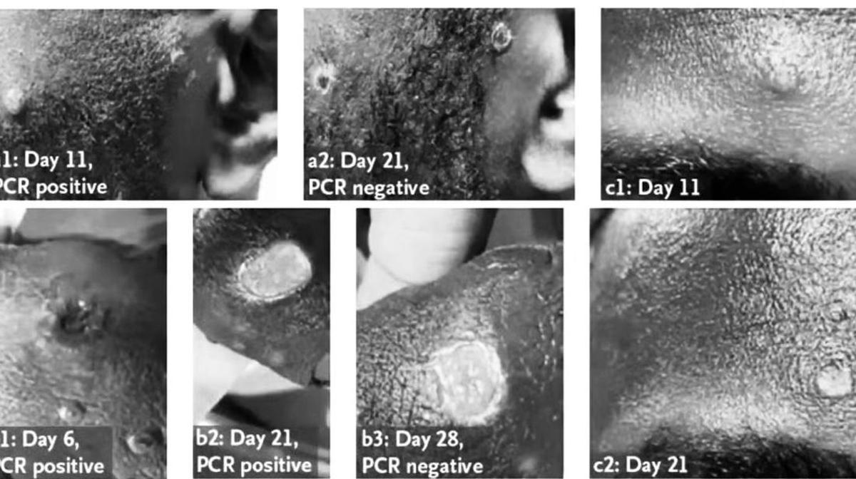 Sudah Ditemukan di Indonesia, Lihat Lagi Ruam Khas Cacar Monyet