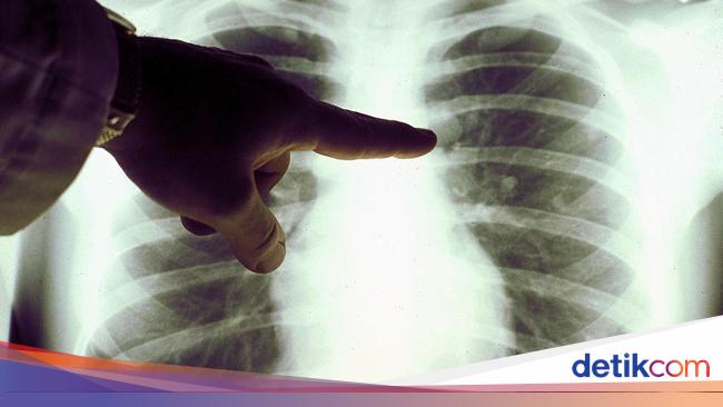Ngeri! Dokter Paru Sebut Uap Vape Bisa Picu Kondisi Langka 'Popcorn Lung'