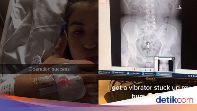 Horor! Viral Wanita Curhat Mainan Seks Nyangkut di Pantat Sampai Harus Operasi