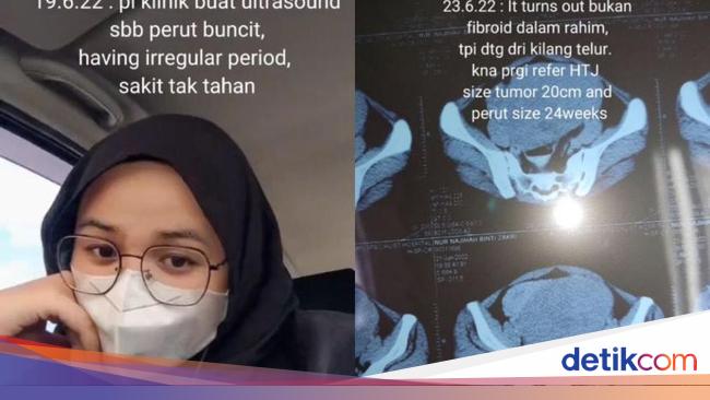 Viral Perut Buncit Dikira Hamil 24 Minggu, Ternyata Kena Tumor dan Kanker