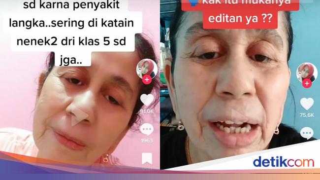 Viral Wanita di Bekasi Mengaku Idap Progeria, Sejak SD Sudah Seperti ... Viral Wanita di Bekasi Mengaku Idap Progeria, Sejak SD Sudah Seperti ...