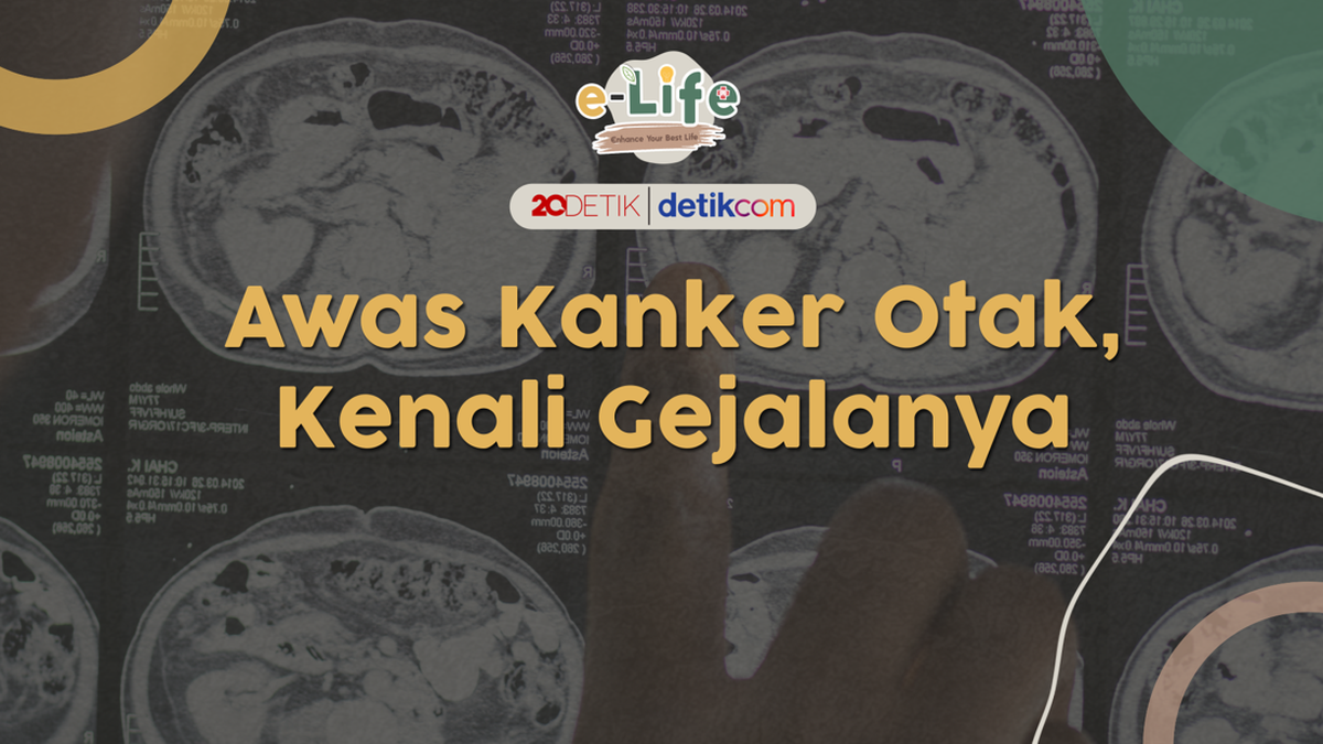 Sakit Kepala karena Kanker Otak, Apa Bedanya? Ini Penjelasan Dokter
