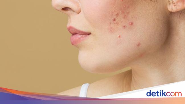 Jerawat Papula, Benjolan Kecil Merah yang Sakit, Ini Penyebabnya