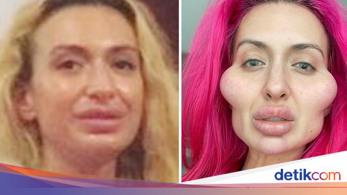 Foto: Transformasi Model dengan Pipi Terbesar, Before-After Suntik Filler