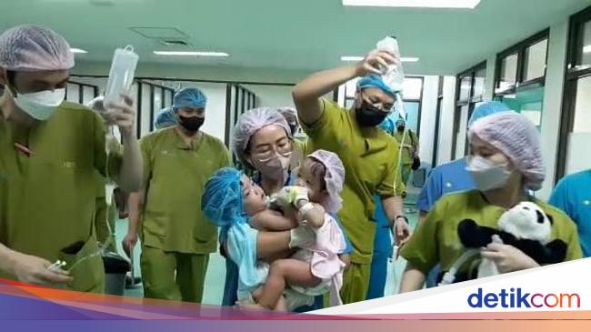 Bayi Kembar Siam Ayesha-Aleeya Asal KBB Jalani Operasi Pemisahan
