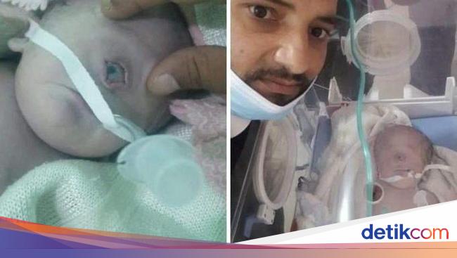 Apa Itu Cyclopia? Heboh Bayi Bermata Satu Lahir di Yaman