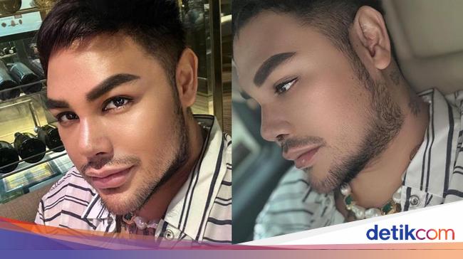 6 Potret Penampilan Hidung Baru Ivan Gunawan Pasca Operasi di Turki