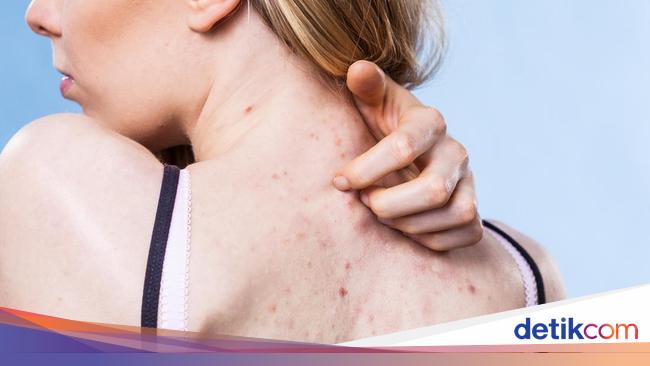 8 Penyebab Jerawat di Punggung dan Cara Mengatasinya