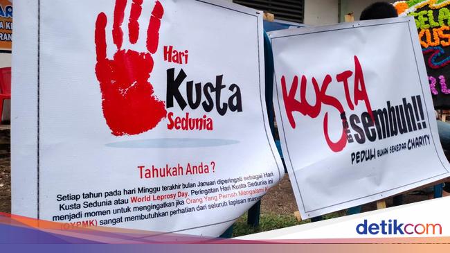 Hari Kusta Sedunia 28 Januari, Pelajari Sejarahnya di Sini