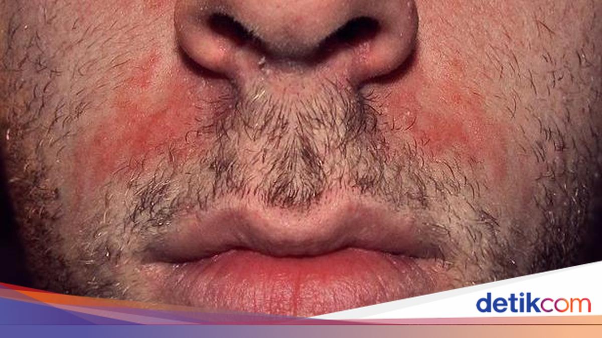 Apa Itu Dermatitis Seboroik? Kenali Gejala, Penyebab, dan Pengobatannya