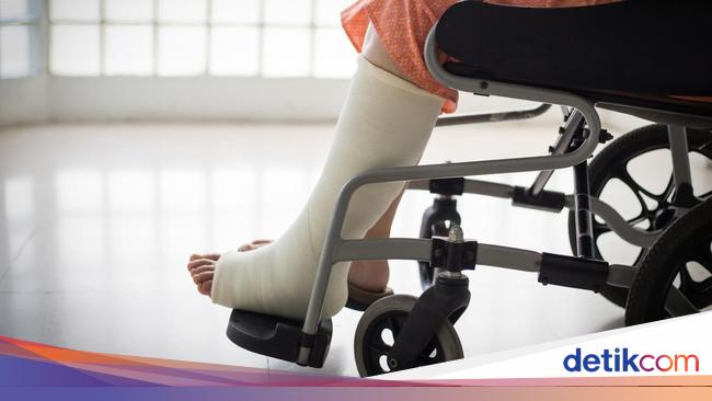 Pengertian Gips: Manfaat, Jenis, Proses Pemasangan, dan Perawatan Gips