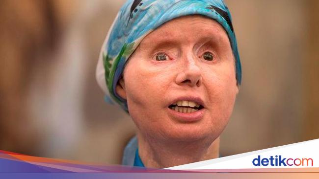 Transformation of Woman Attacked by Chimpanzees Until Face Deformed ...