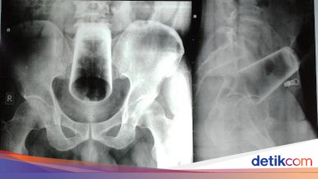 6 Kasus Benda Asing di Tubuh Tertangkap X-Ray, Ada Gelas Nyangkut di Dubur