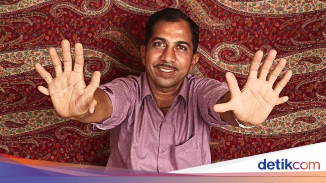 Potret Manusia dengan Jari Terbanyak di Dunia, Kerap Sulit Berjalan