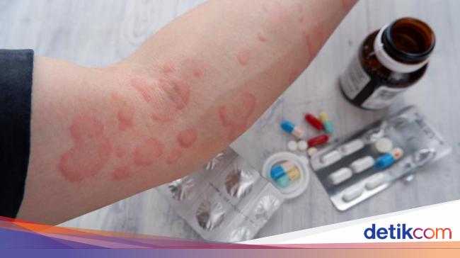 Reaksi Alergi Syok Anafilaktik Bisa Ancam Jiwa, Ini Cara Mencegahnya