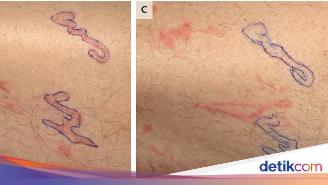 Ngeri, Begini Penampakan Cacing Bersarang di Bawah Kulit Pria Ini