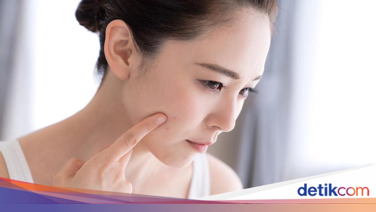 6 Skincare untuk Menghilangkan Bekas Jerawat, Ini Rahasia Kulit Mulus!