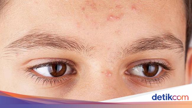 6 Penyebab Jerawat di Dahi dan Cara Mengatasinya agar Cepat Hilang