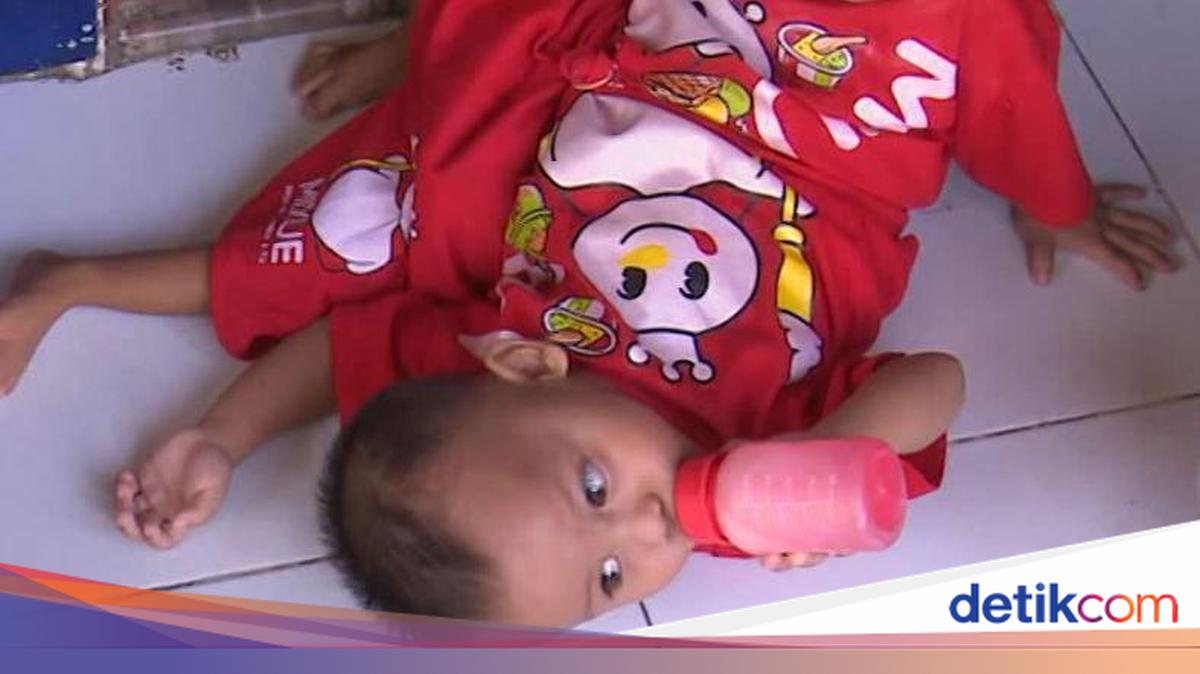 Mari Bantu Adam dan Malika, Anak Kuli Serabutan yang Lahir Kembar Siam