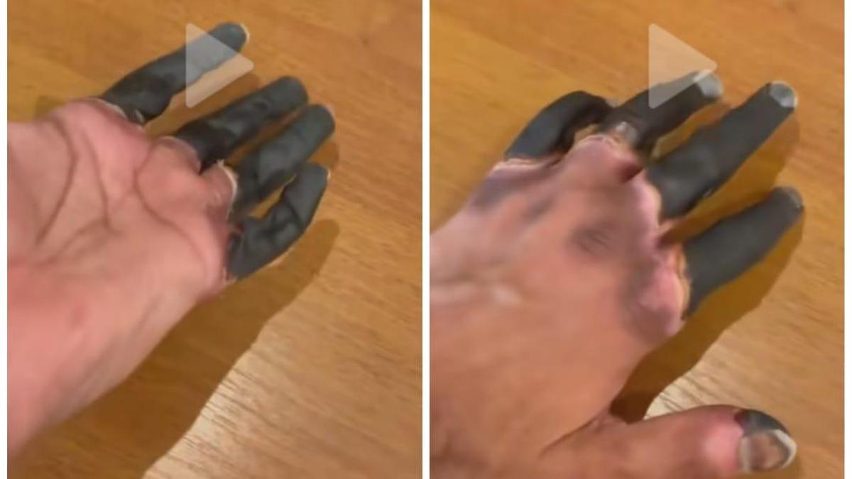 Mengenal Frostbite, Viral di TikTok Jari Menghitam-Membeku Bak Lilin