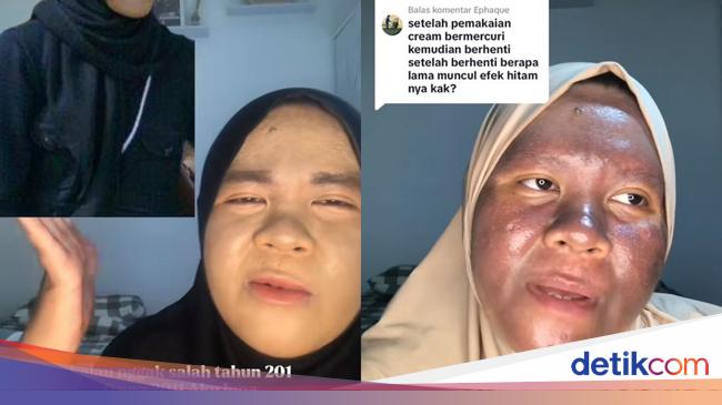 Dokter Ungkap Penjelasan Medis di Balik Viral Kulit 'Gosong' gegara ...