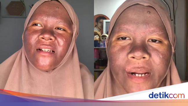 Viral Wajah Wanita 'Gosong' gegara Skincare Bermerkuri, Bisa Sembuh?