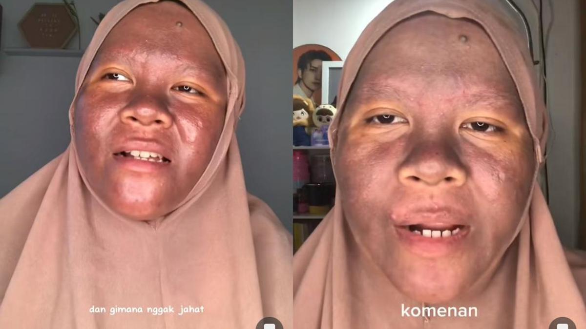 Nasib Wanita di Kaltim Muka Mendadak Gosong usai Pakai Krim Abal-abal ...