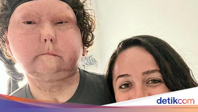 Kisah Wanita yang Jatuh Cinta dengan Pria yang Wajahnya Hasil Transplantasi