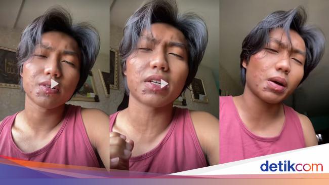 Viral Pria Ngeluh Bintik-bintik Nyaris di Seluruh Wajah, Dituding Kena Sifilis