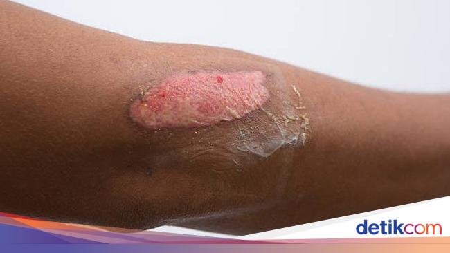 Jenis Derajat Luka Bakar: Tanda, Penyebab, dan Cara Penanganannya