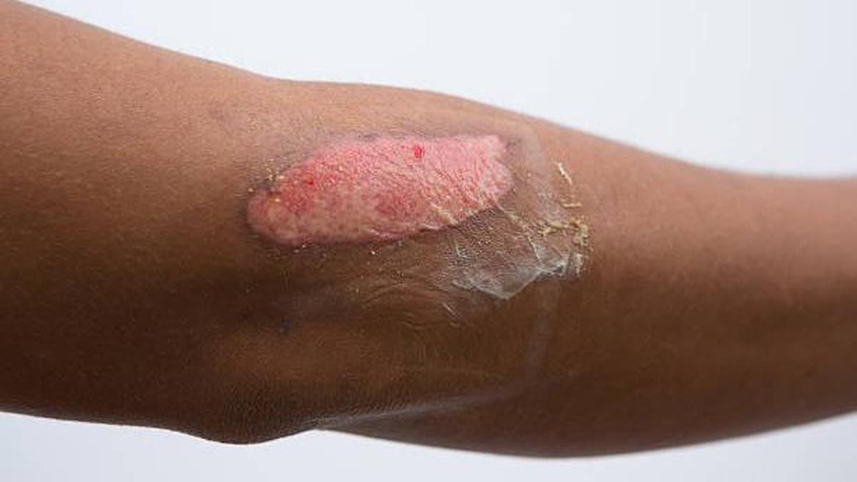 Jenis Derajat Luka Bakar: Tanda, Penyebab, dan Cara Penanganannya