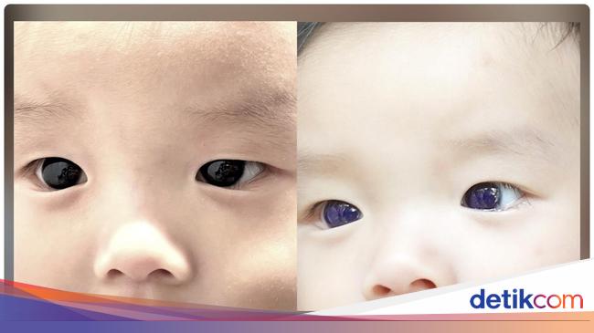 Viral Mata Bayi di Thailand Berubah Jadi Biru usai Perawatan COVID-19