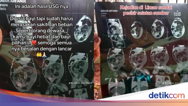 Viral Bayi 5 Bulan 'Hamil' Diduga Fetus in Fetu, Kondisi Apa Itu?