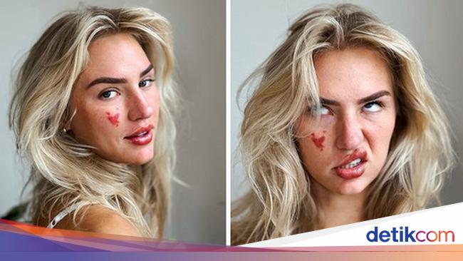 Influencer Ini Diejek Wajahnya Karena Punya Tompel di Muka, Beri Pesan ...
