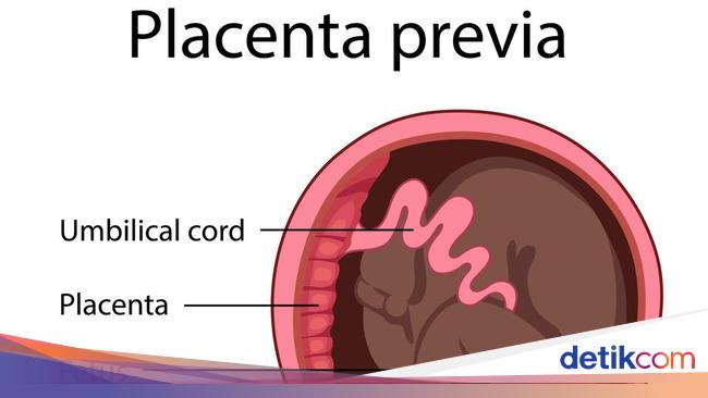 Plasenta Previa: Jenis, Penyebab, Gejala, dan Cara Mencegahnya